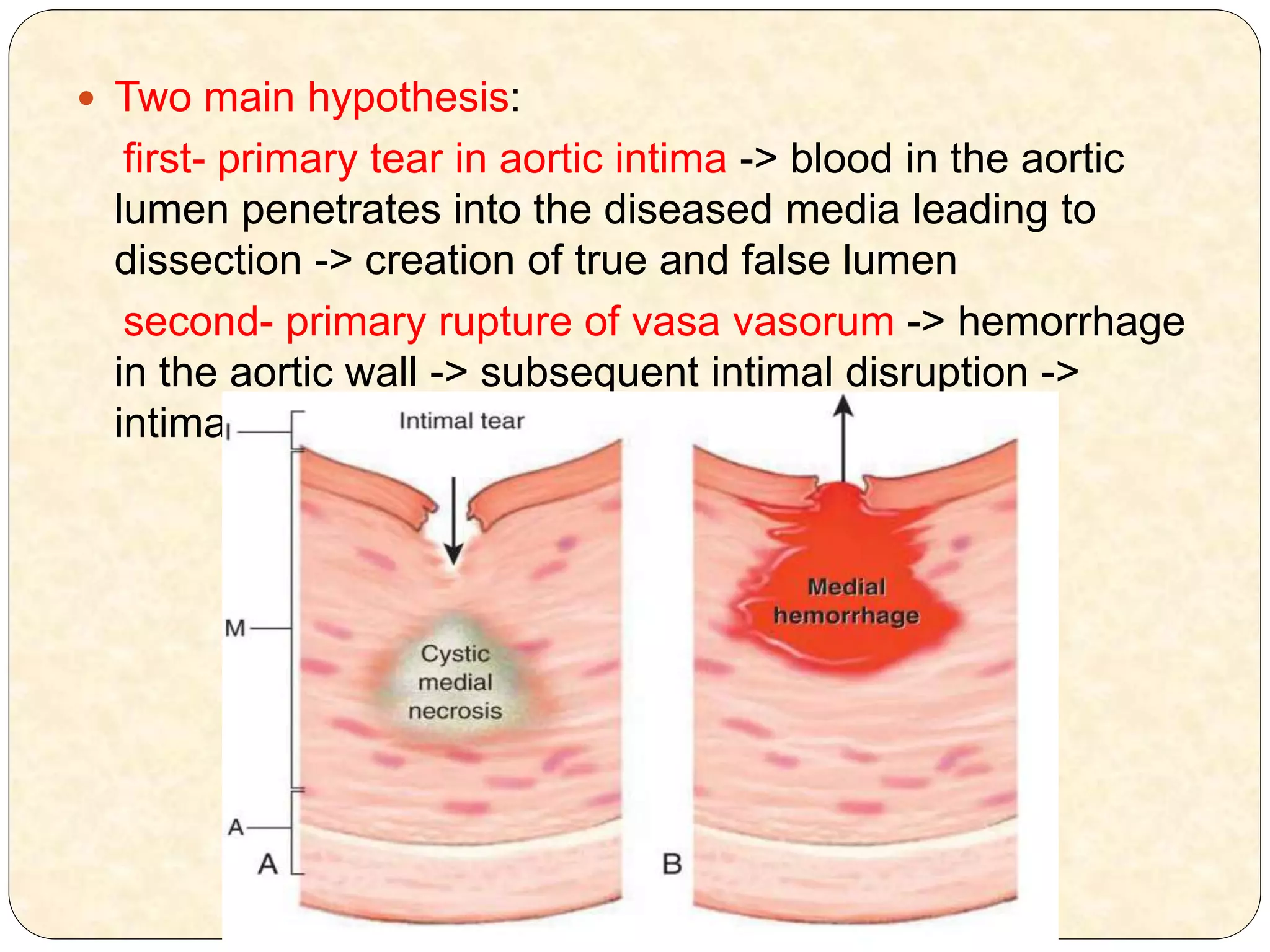 Aortic dissection | PPTX