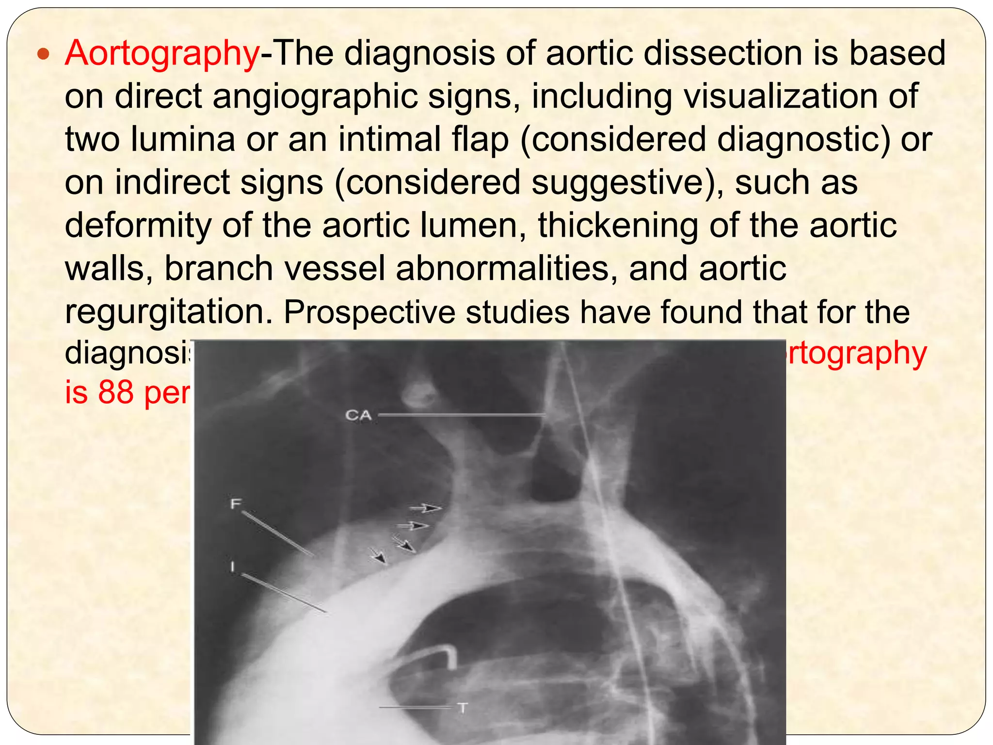 Aortic dissection | PPTX