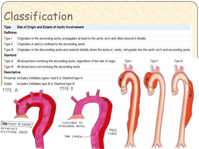 Aortic dissection
