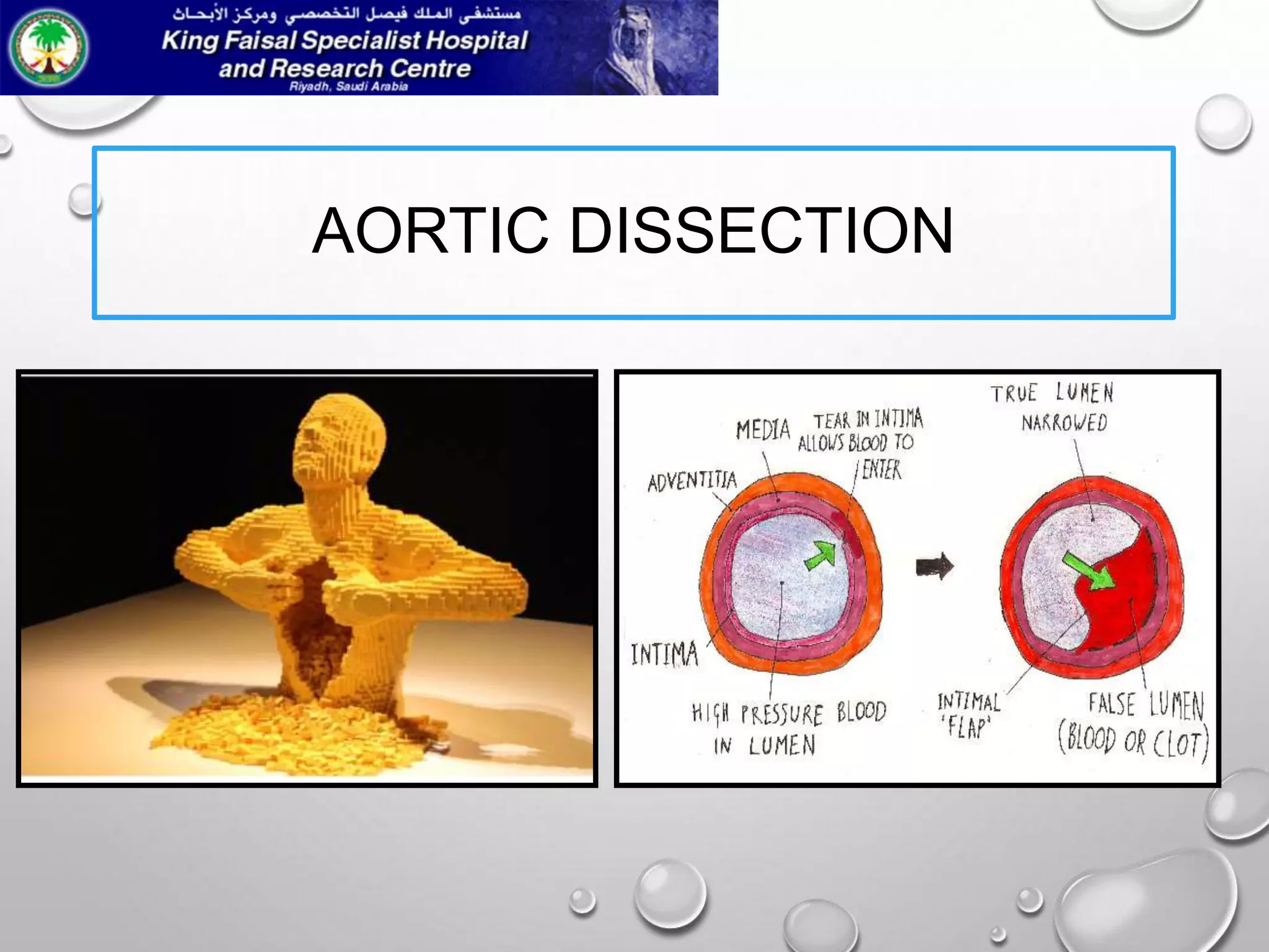 Aortic dissection, pathophysiology, risk, incidence, types and ...