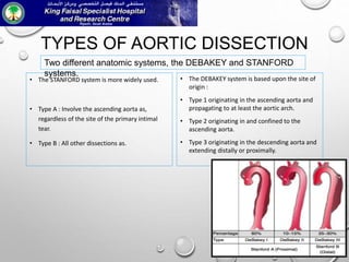Aortic dissection, pathophysiology, risk, incidence, types and ...