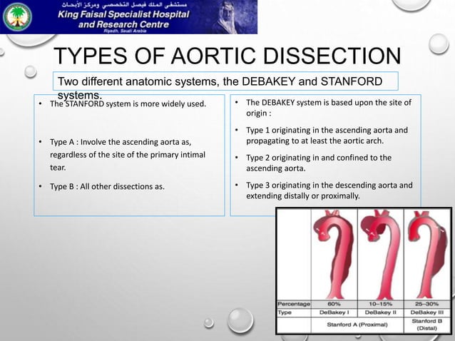 Aortic dissection, pathophysiology, risk, incidence, types and ...