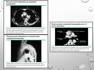 Aortic dissection, pathophysiology, risk, incidence, types and ...