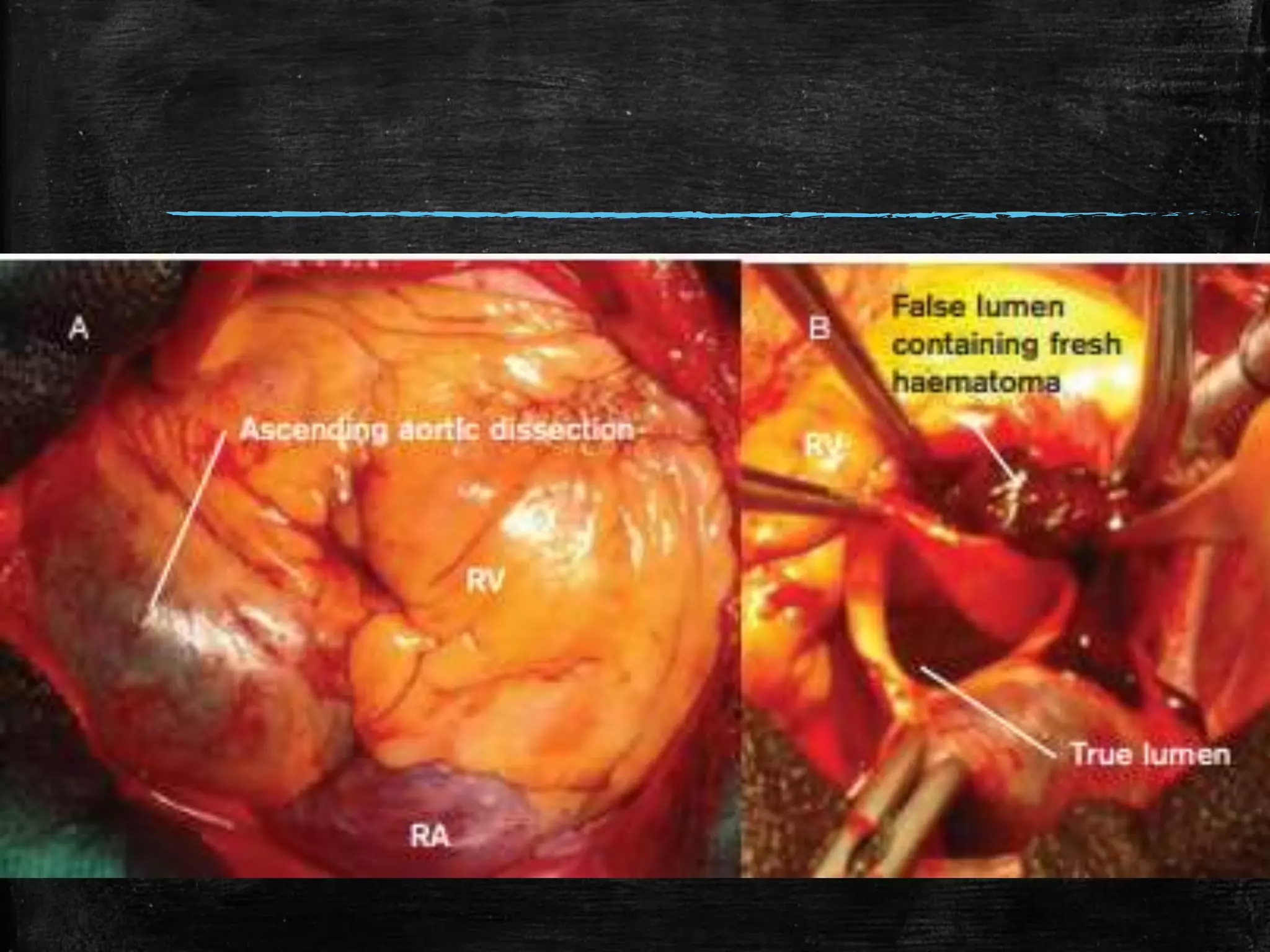 Aortic dissection | PPT