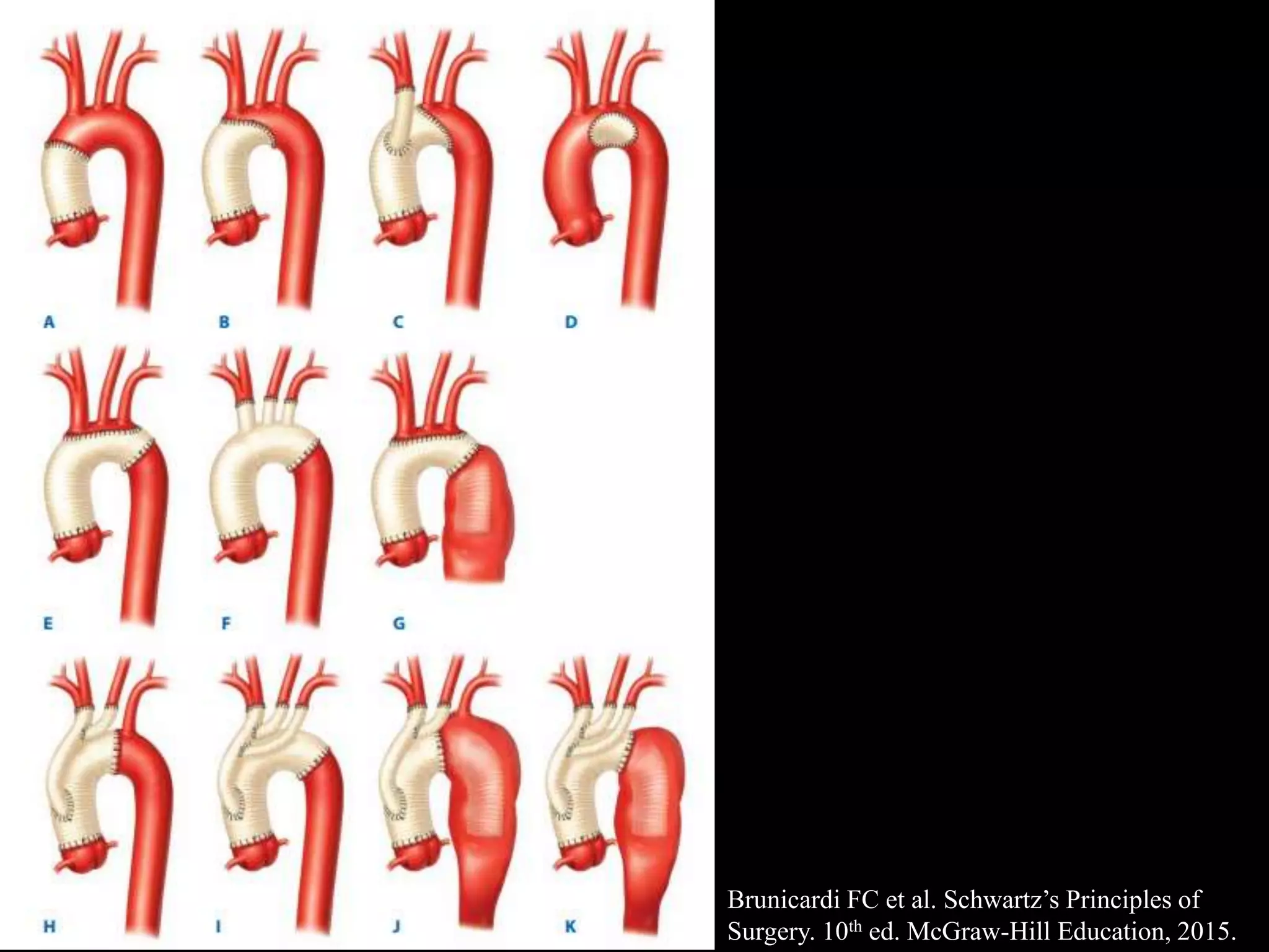 Aortic dissection | PPTX