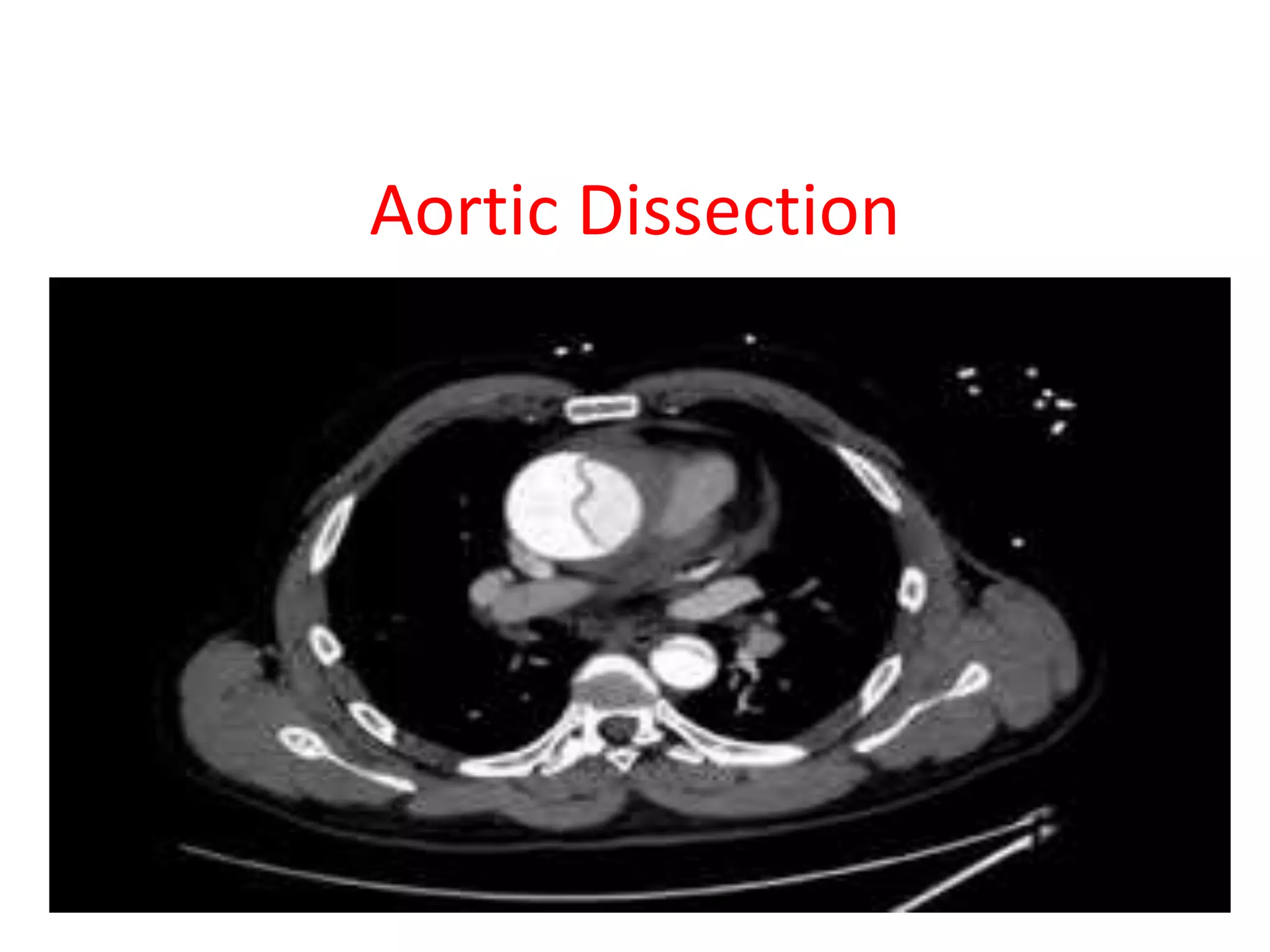 Aortic dissection | PPTX