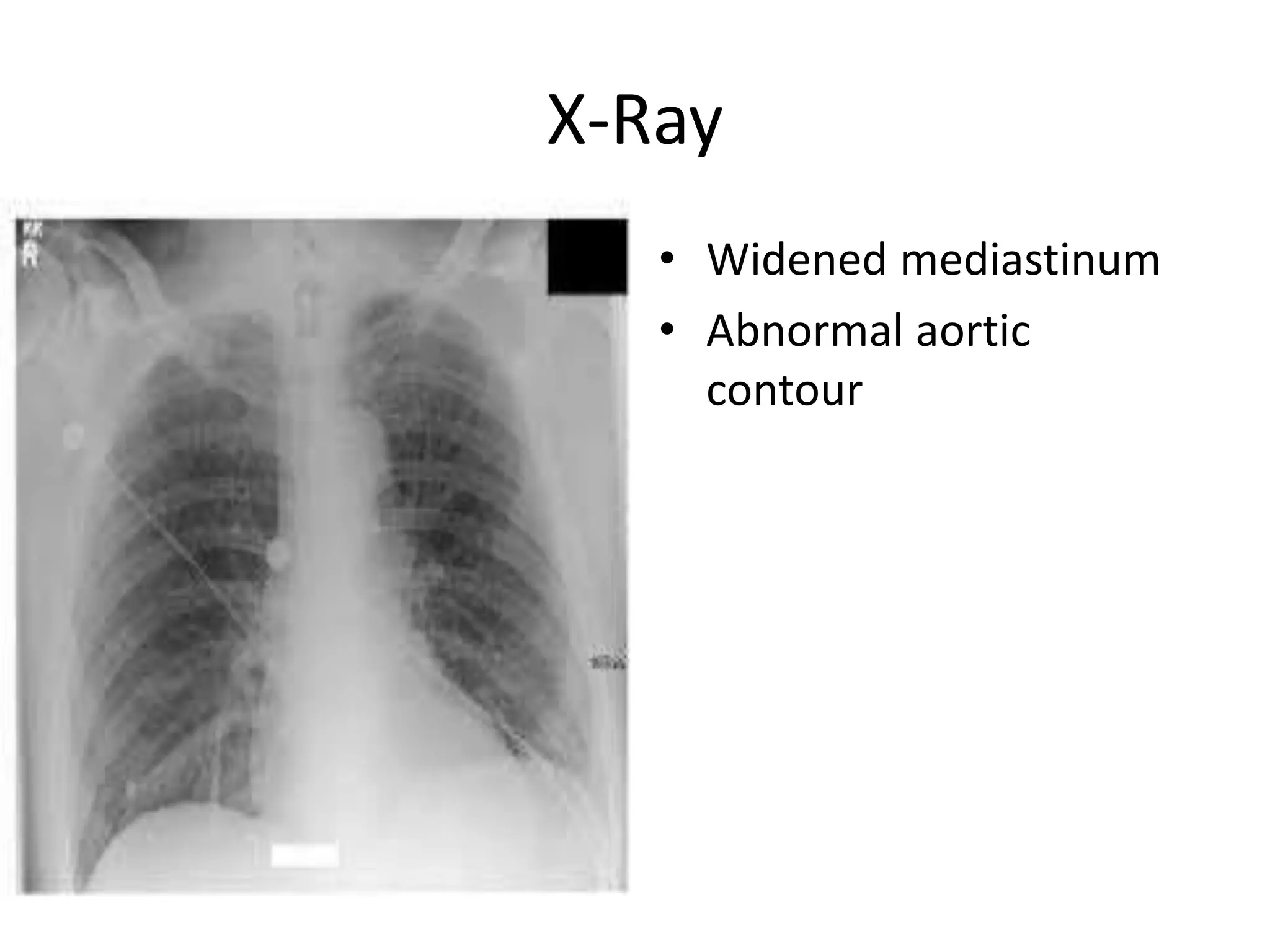 Aortic dissection | PPTX