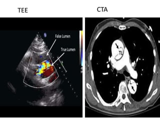 Aortic dissection | PPTX | Heart and Cardiovascular Diseases | Diseases ...