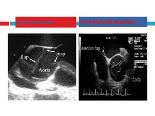Diagnosis and management of aortic dissection | PPTX