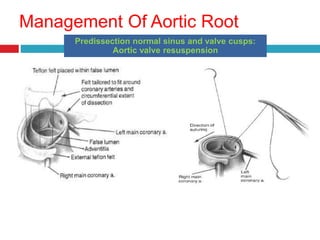 Diagnosis and management of aortic dissection | PPTX