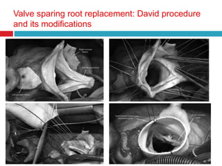 Diagnosis and management of aortic dissection | PPTX