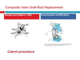Diagnosis and management of aortic dissection | PPTX