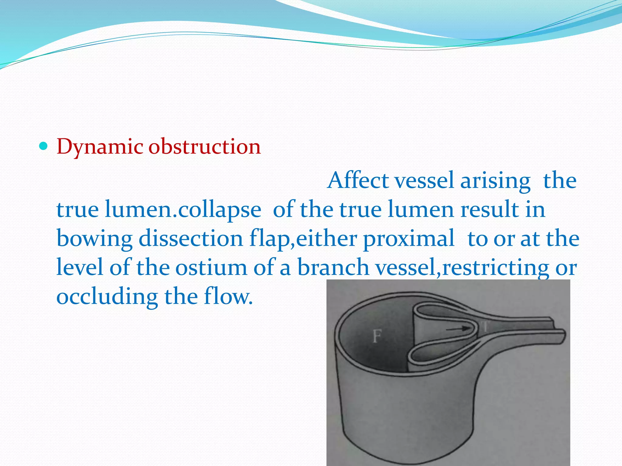Aortic dissection | PPTX