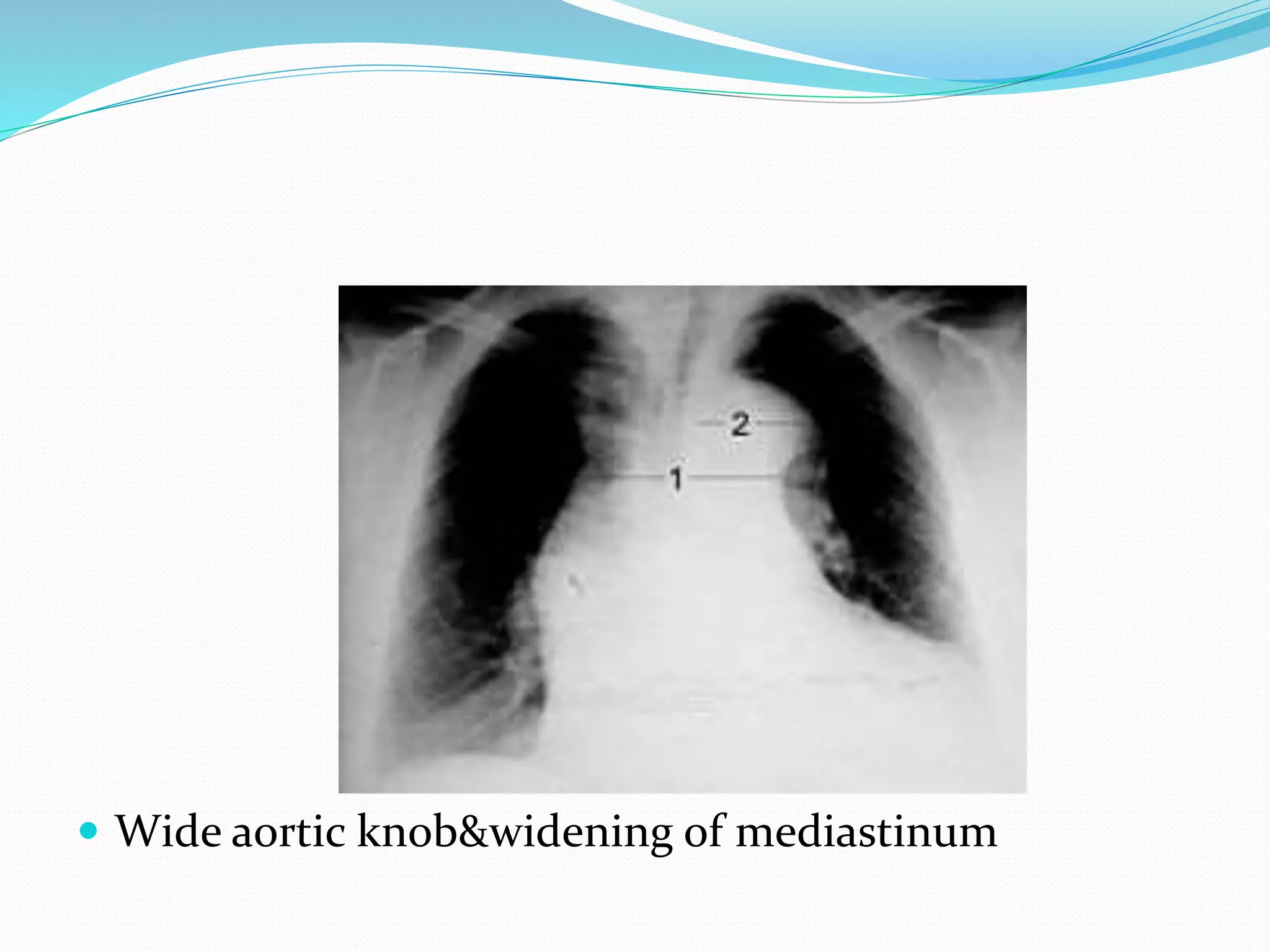 Aortic dissection | PPTX