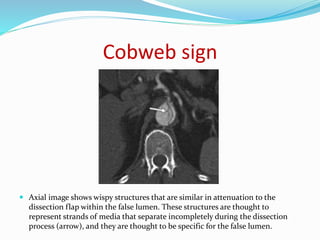 Aortic dissection | PPTX
