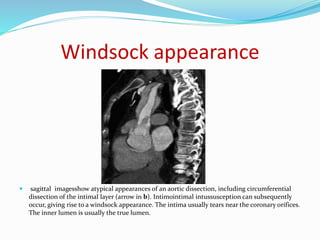 Aortic dissection | PPT