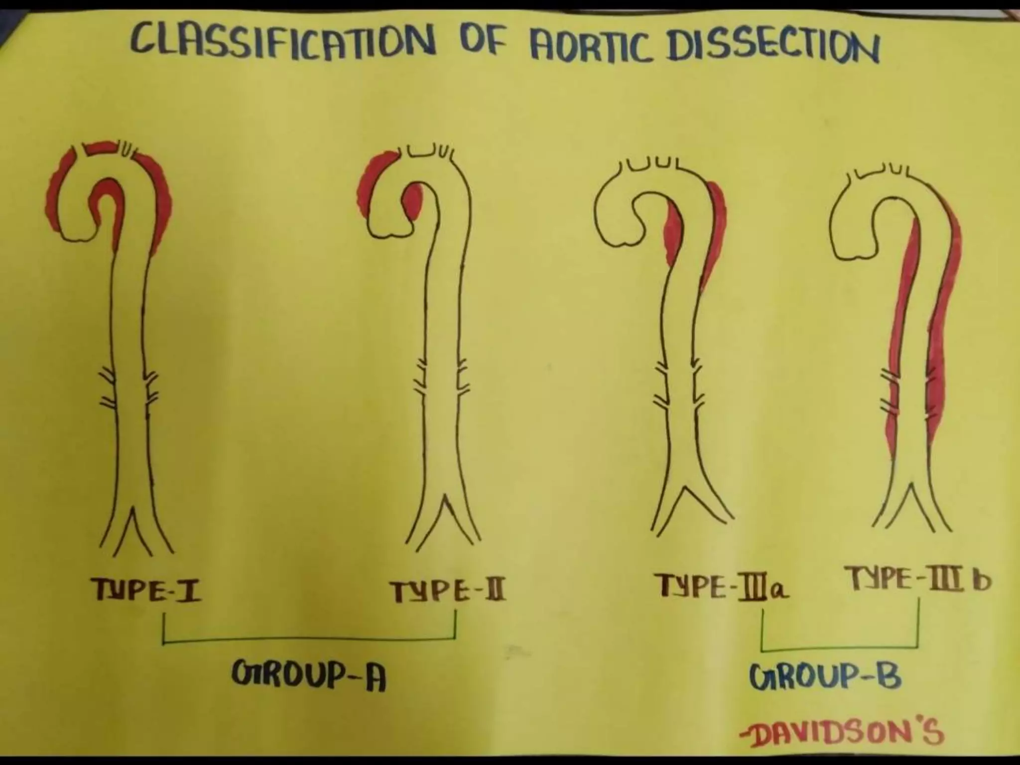 AORTIC DISSECTION | PPTX