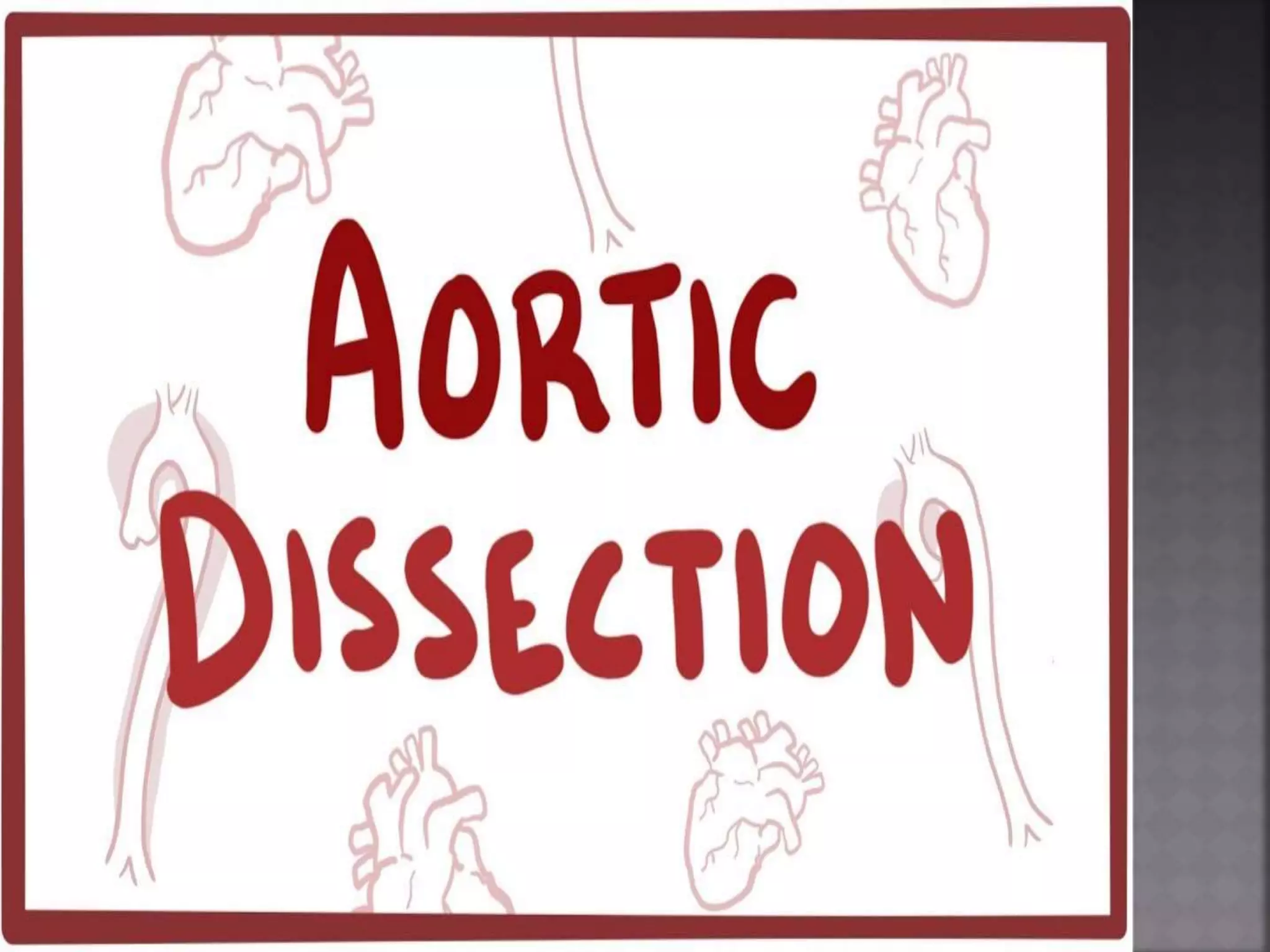 AORTIC DISSECTION | PPTX