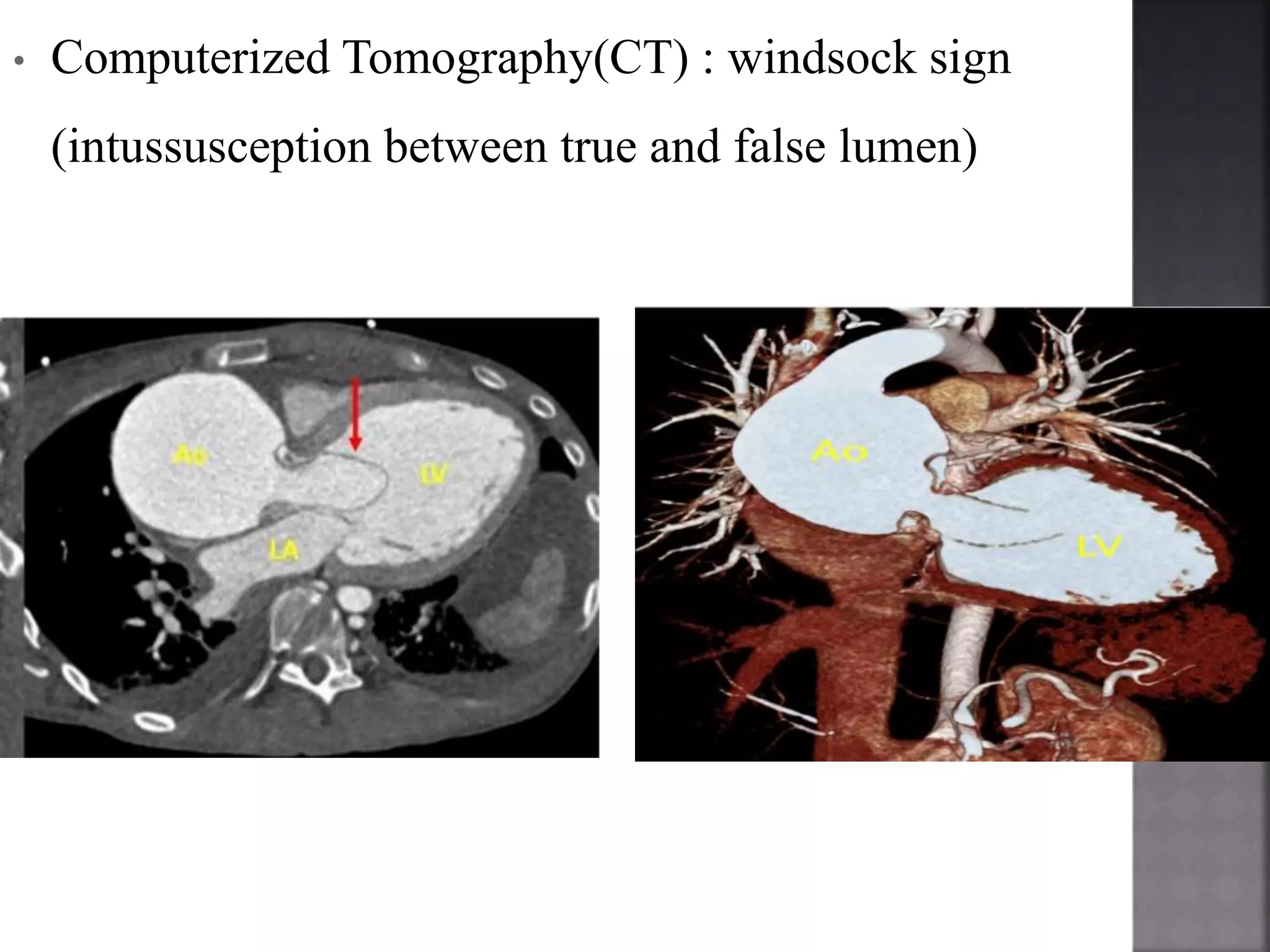 AORTIC DISSECTION | PPTX