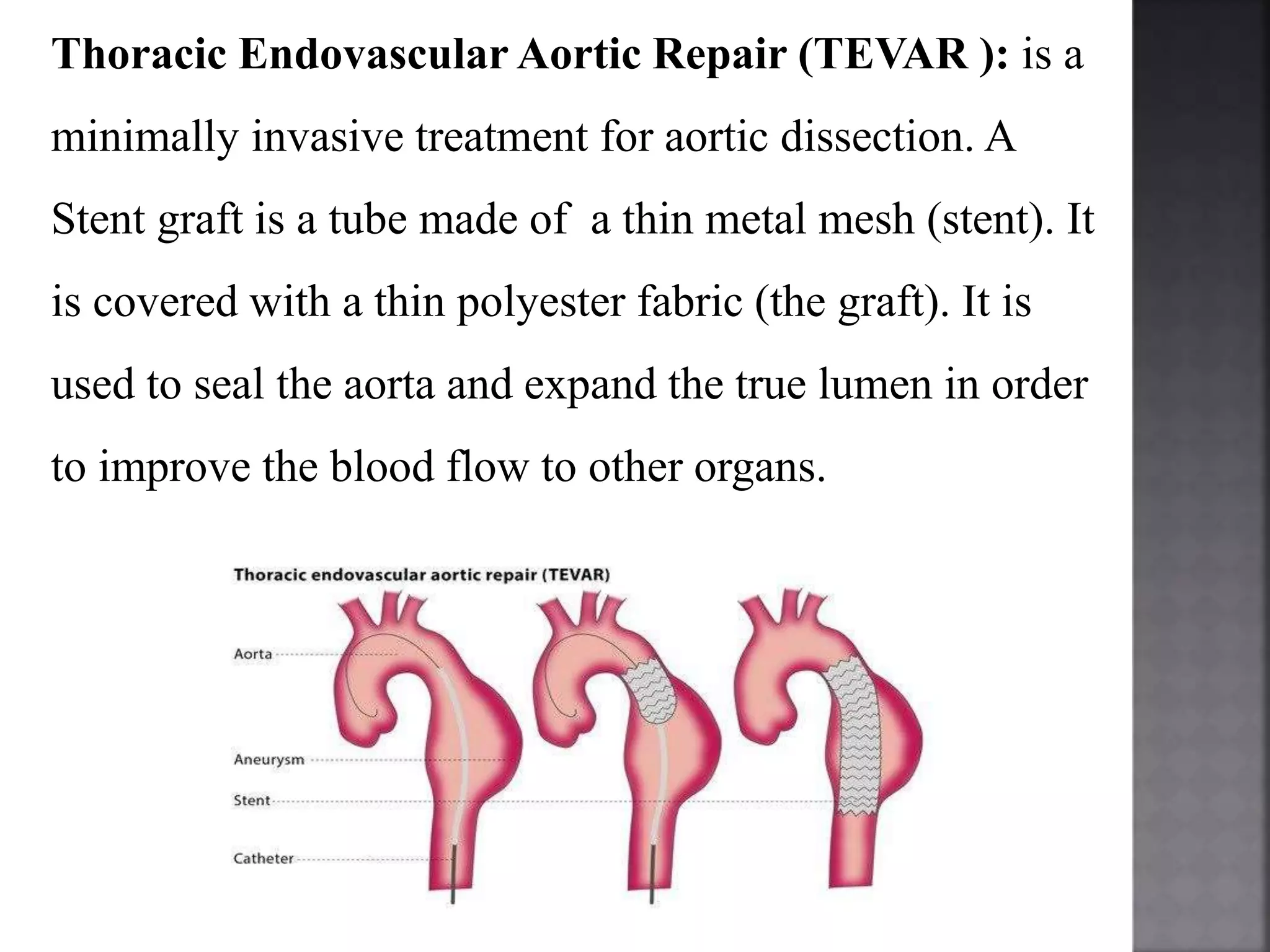 AORTIC DISSECTION | PPTX