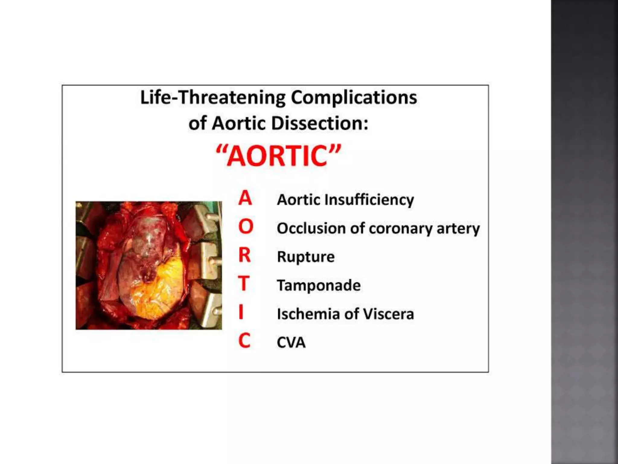 AORTIC DISSECTION | PPTX