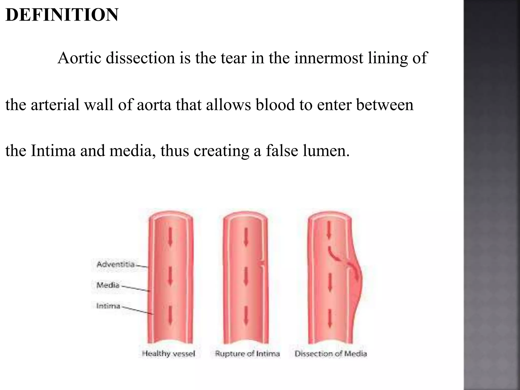 AORTIC DISSECTION | PPTX