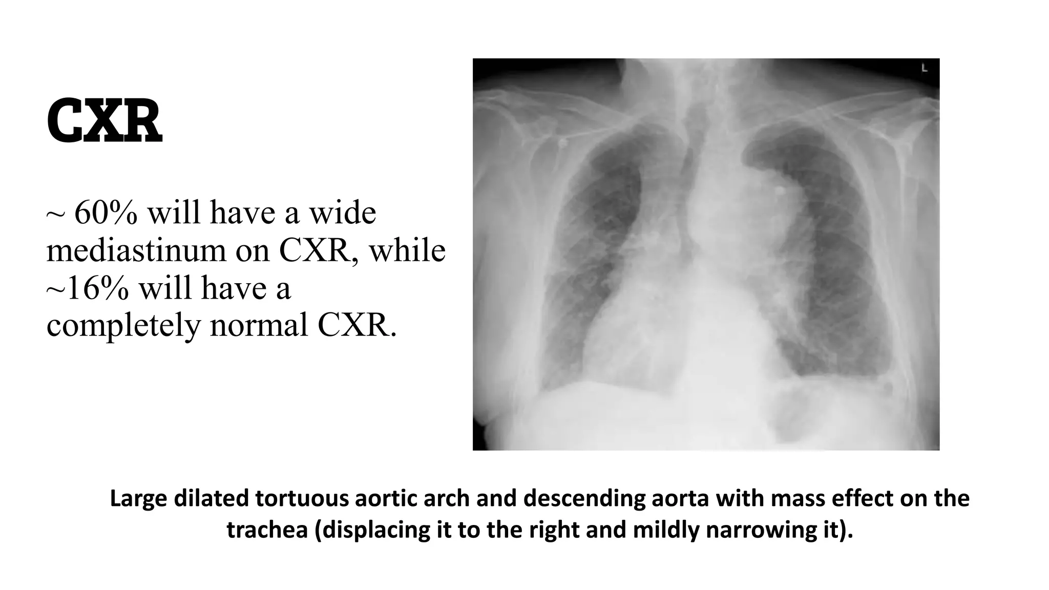 Aortic dissection .pptx