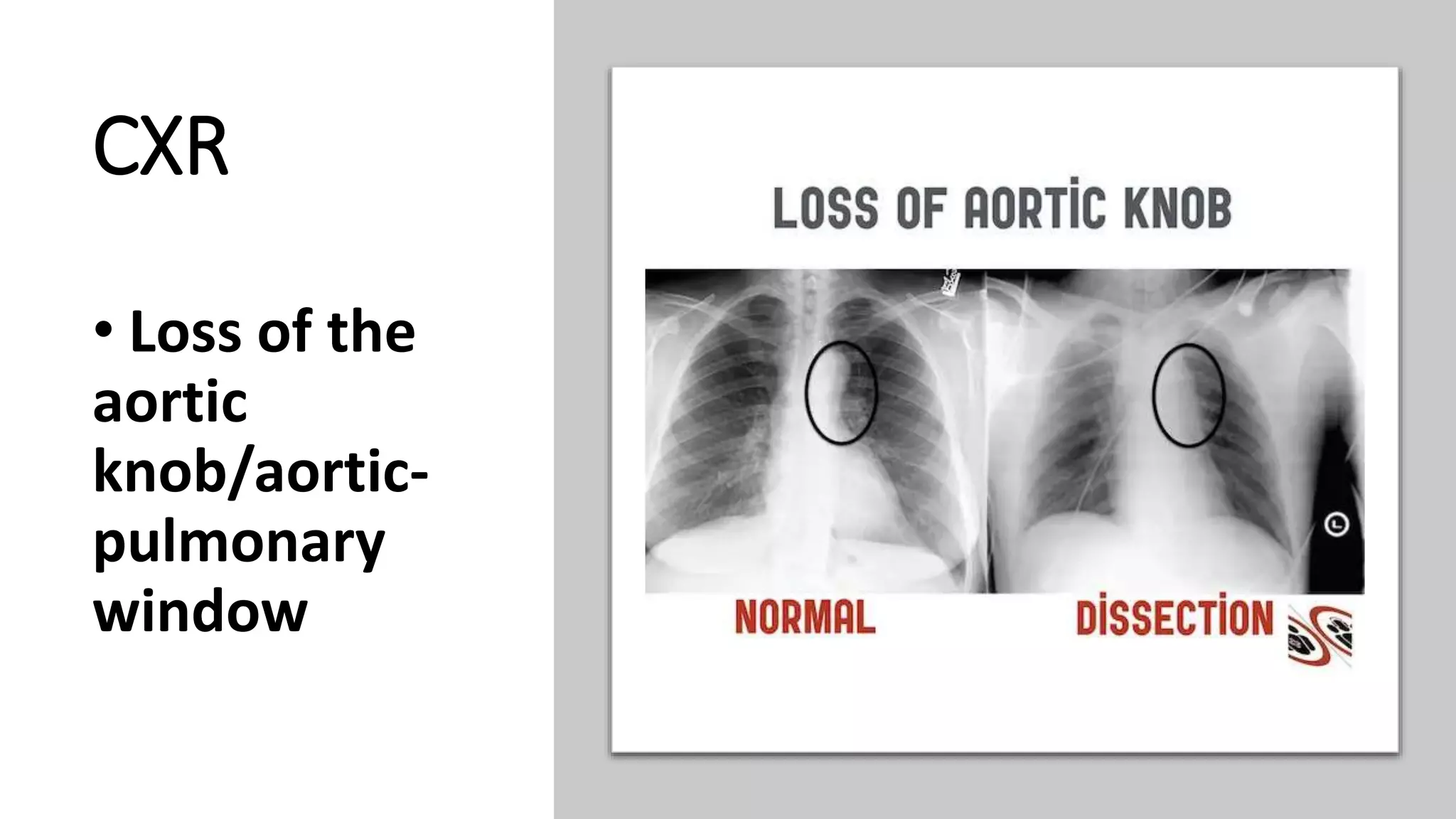 Aortic dissection .pptx