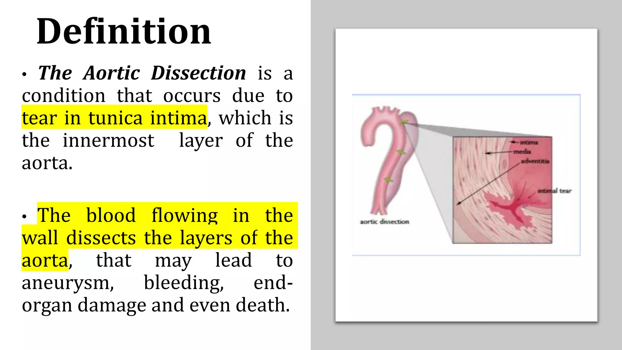 Aortic dissection .pptx