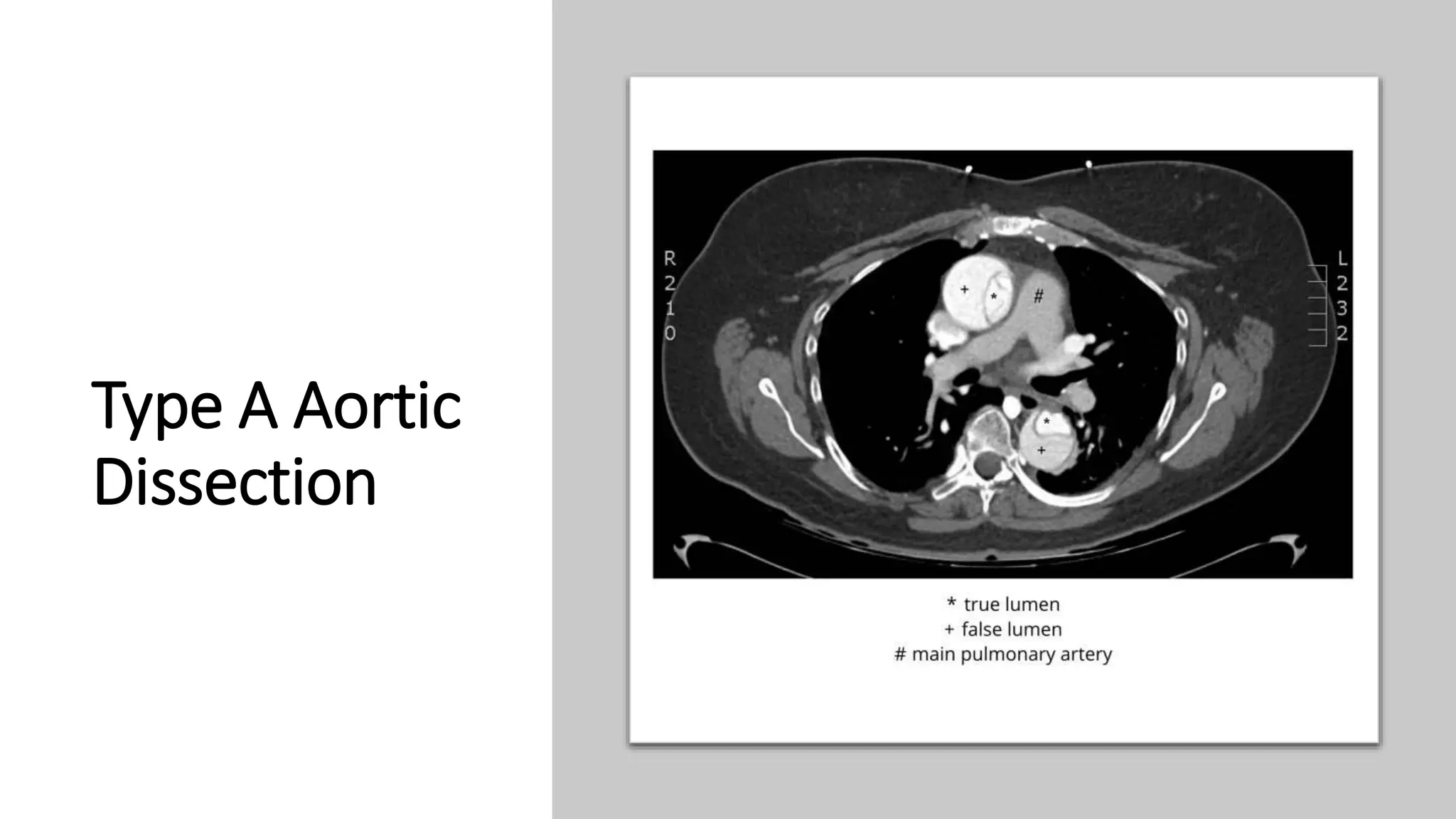 Aortic dissection .pptx