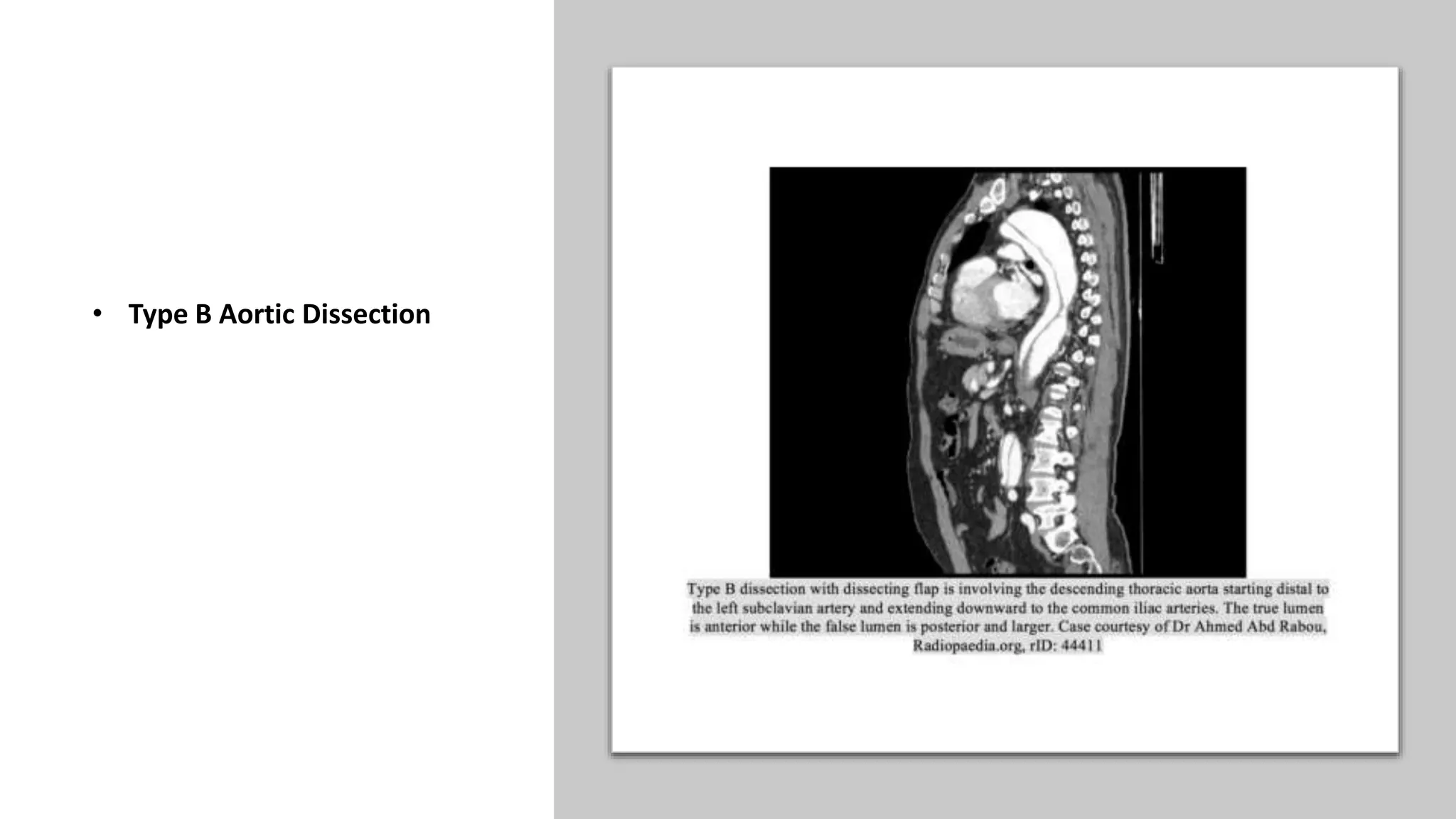 Aortic dissection .pptx