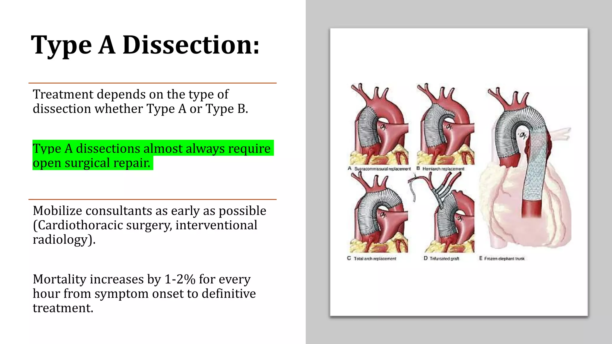 Aortic dissection .pptx