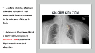 Aortic dissection .pptx