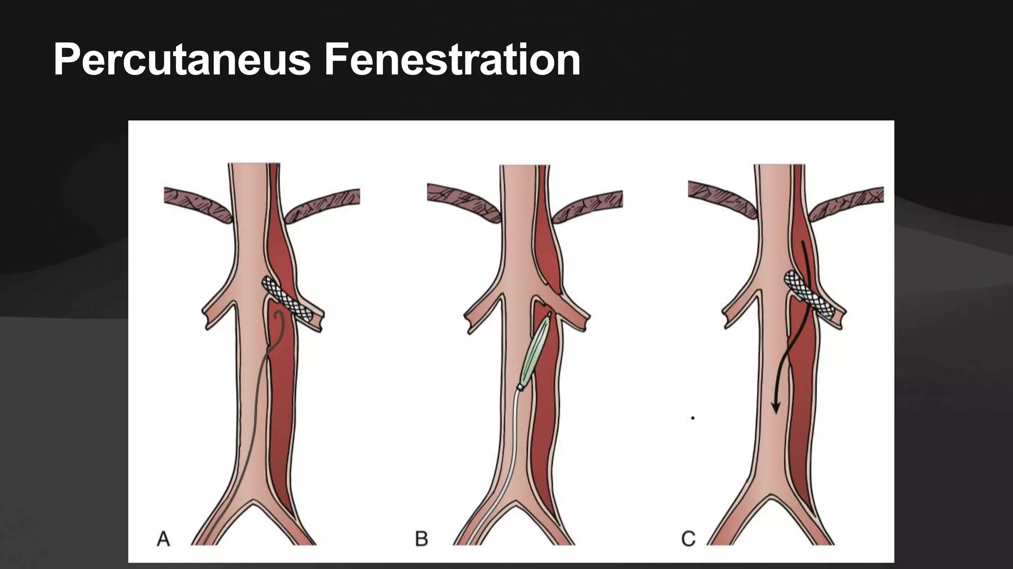 Aortic Dissection.pptx