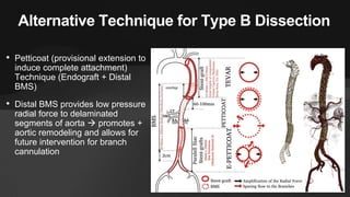 Aortic Dissection.pptx