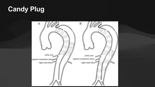 Aortic Dissection.pptx