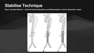 Aortic Dissection.pptx