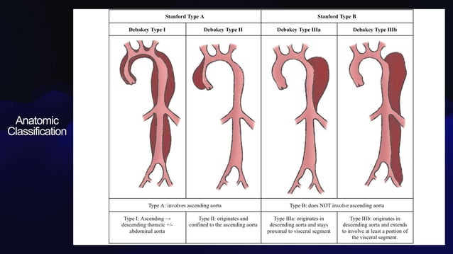 Aortic Dissection.pptx | Heart and Cardiovascular Diseases | Diseases ...