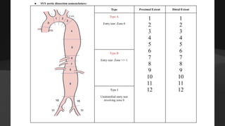 Aortic Dissection.pptx