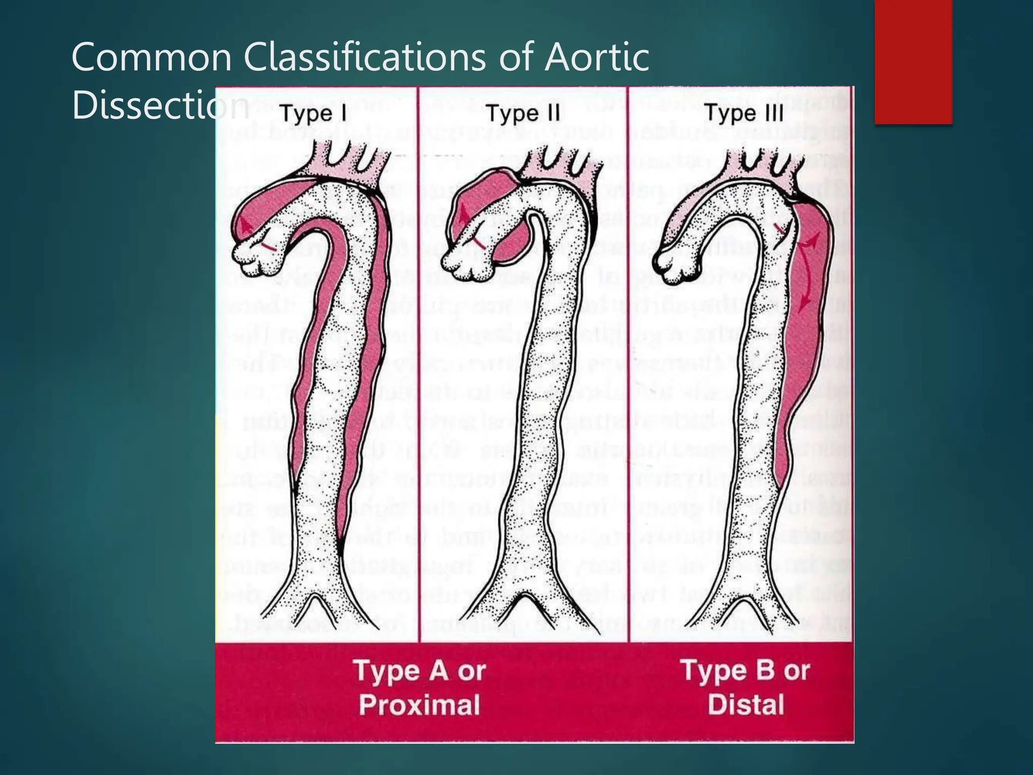 AORTIC DISSECTION and management of aortic dissection | PPTX | Heart ...