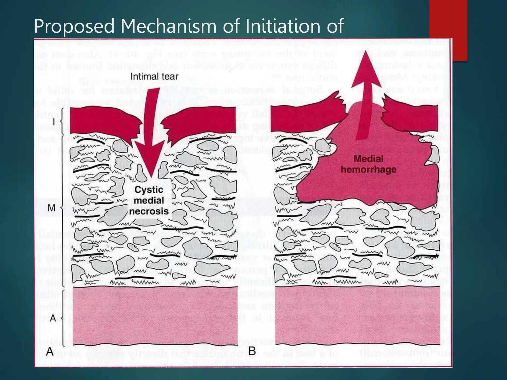 AORTIC DISSECTION and management of aortic dissection | PPTX