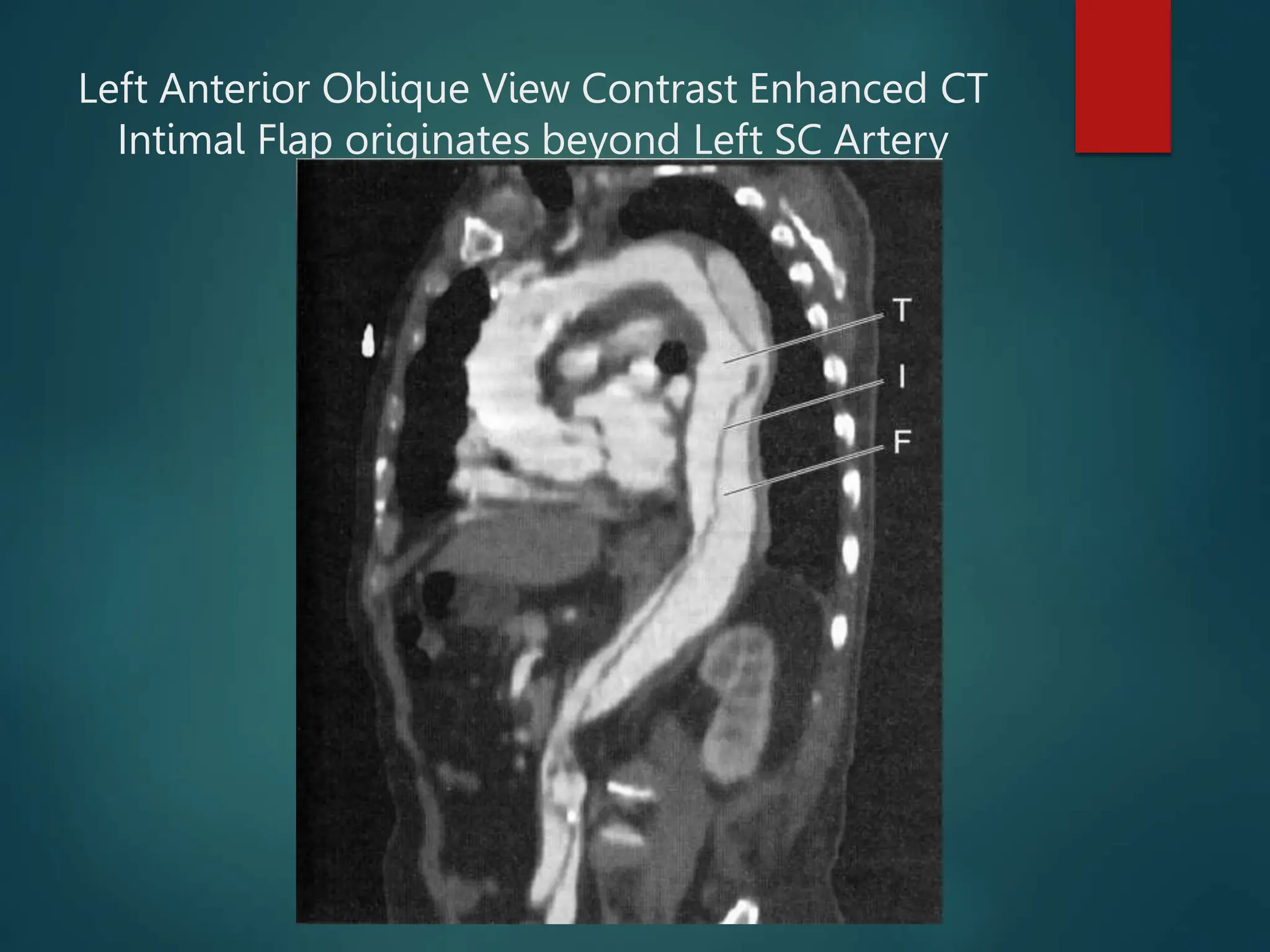 AORTIC DISSECTION and management of aortic dissection | PPTX