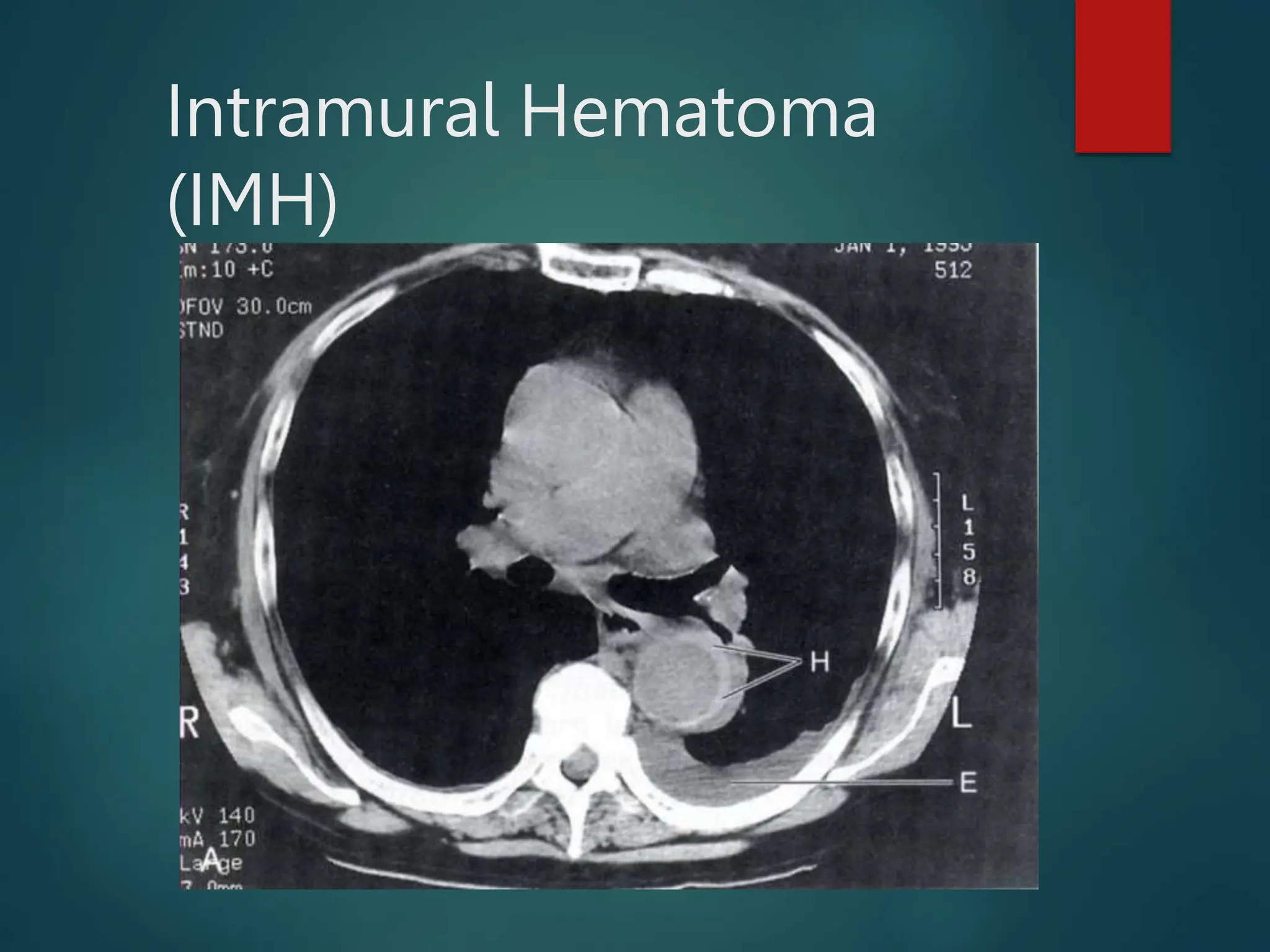 AORTIC DISSECTION and management of aortic dissection | PPTX