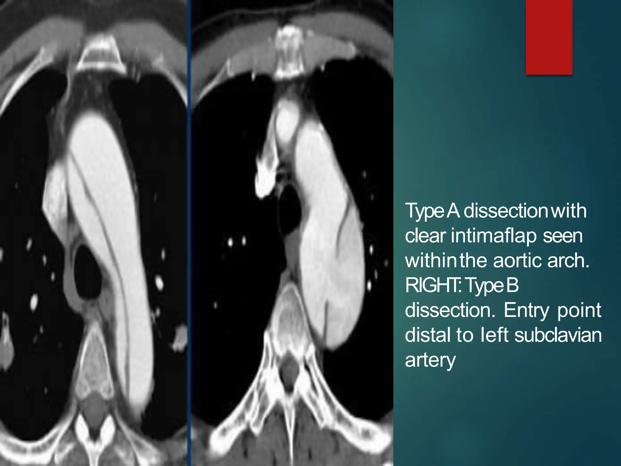 AORTIC DISSECTION and management of aortic dissection | PPTX