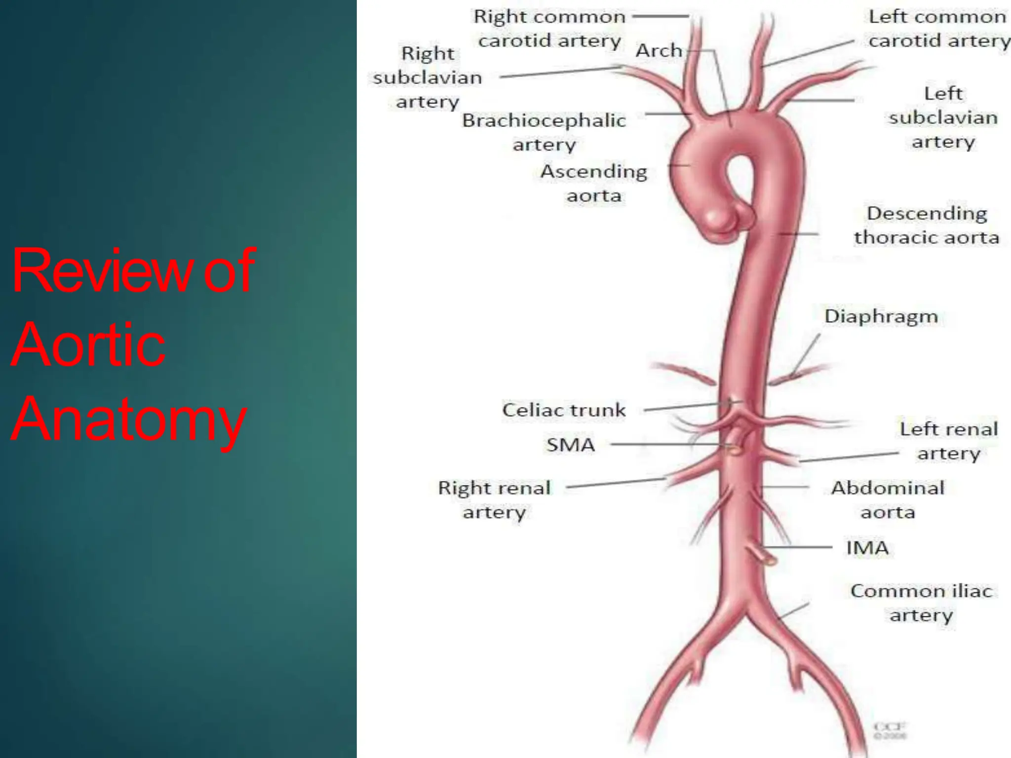 AORTIC DISSECTION and management of aortic dissection | PPTX