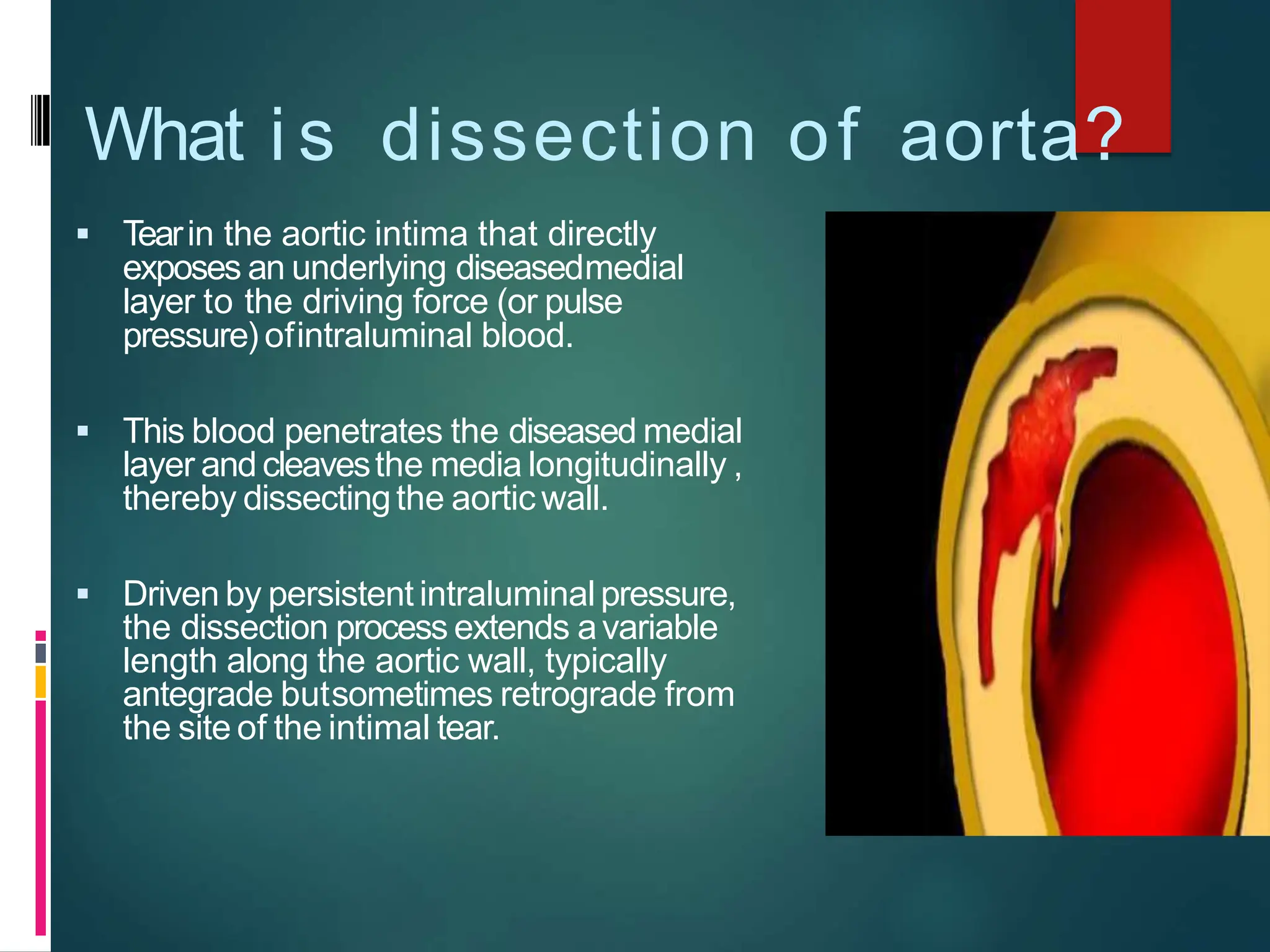 AORTIC DISSECTION and management of aortic dissection | PPTX | Heart ...