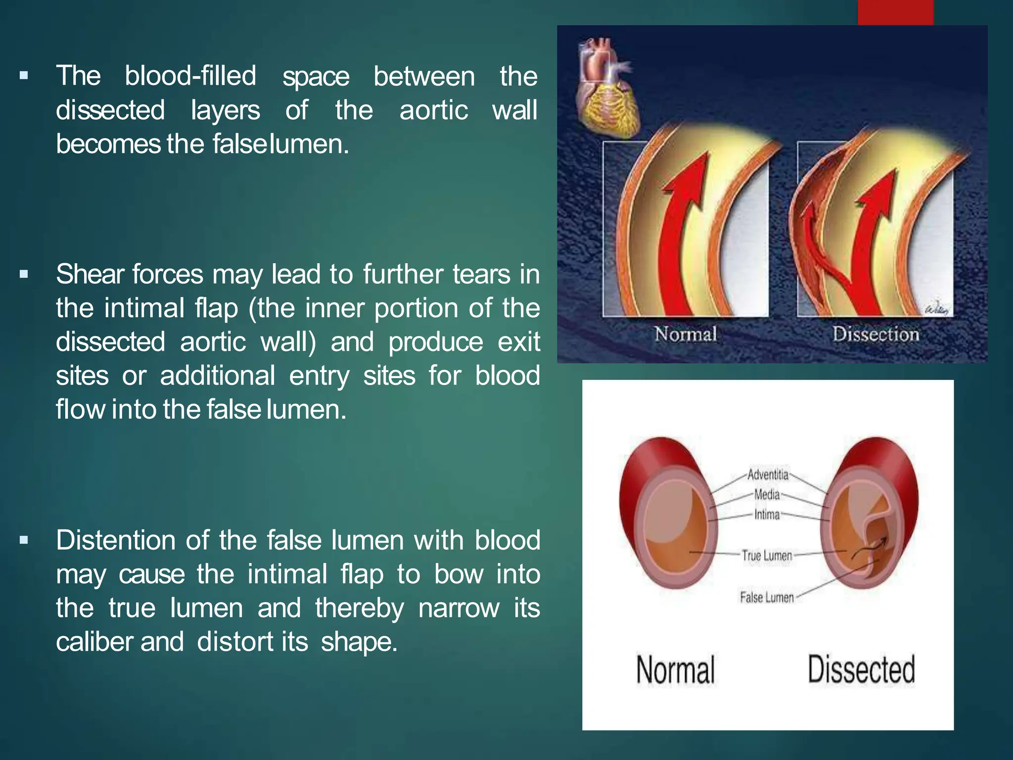 AORTIC DISSECTION and management of aortic dissection | PPTX