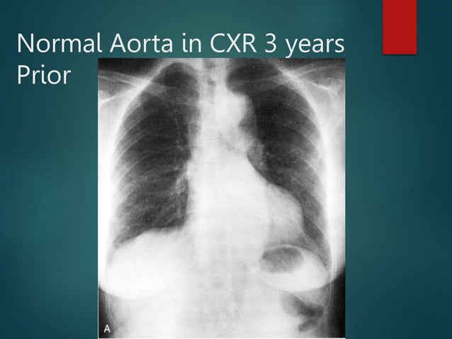 AORTIC DISSECTION and management of aortic dissection | PPTX | Heart ...