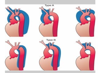 Case presentation of aortic dissection.pptx
