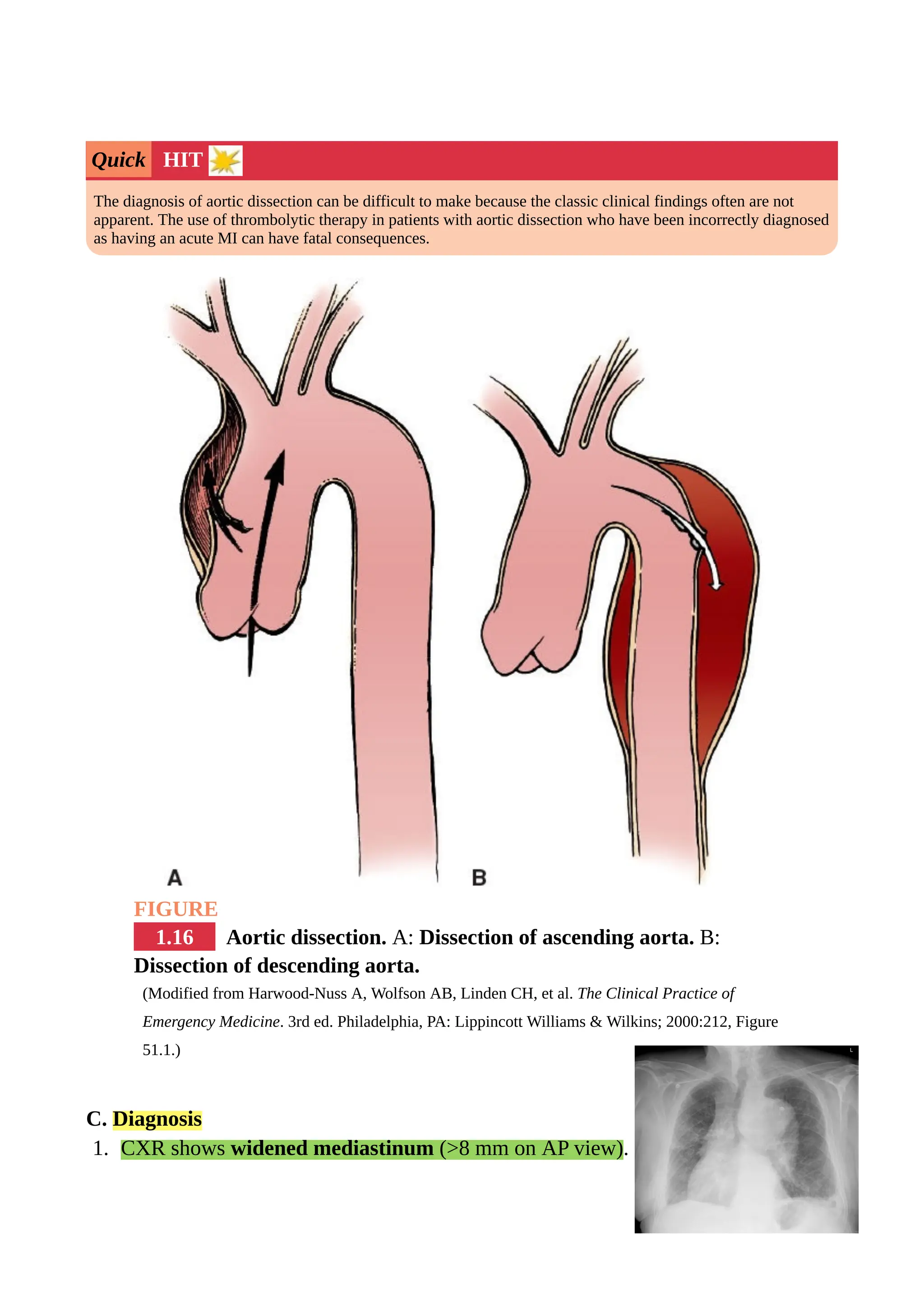 Aortic Dissection (cardiovascular system) | PDF